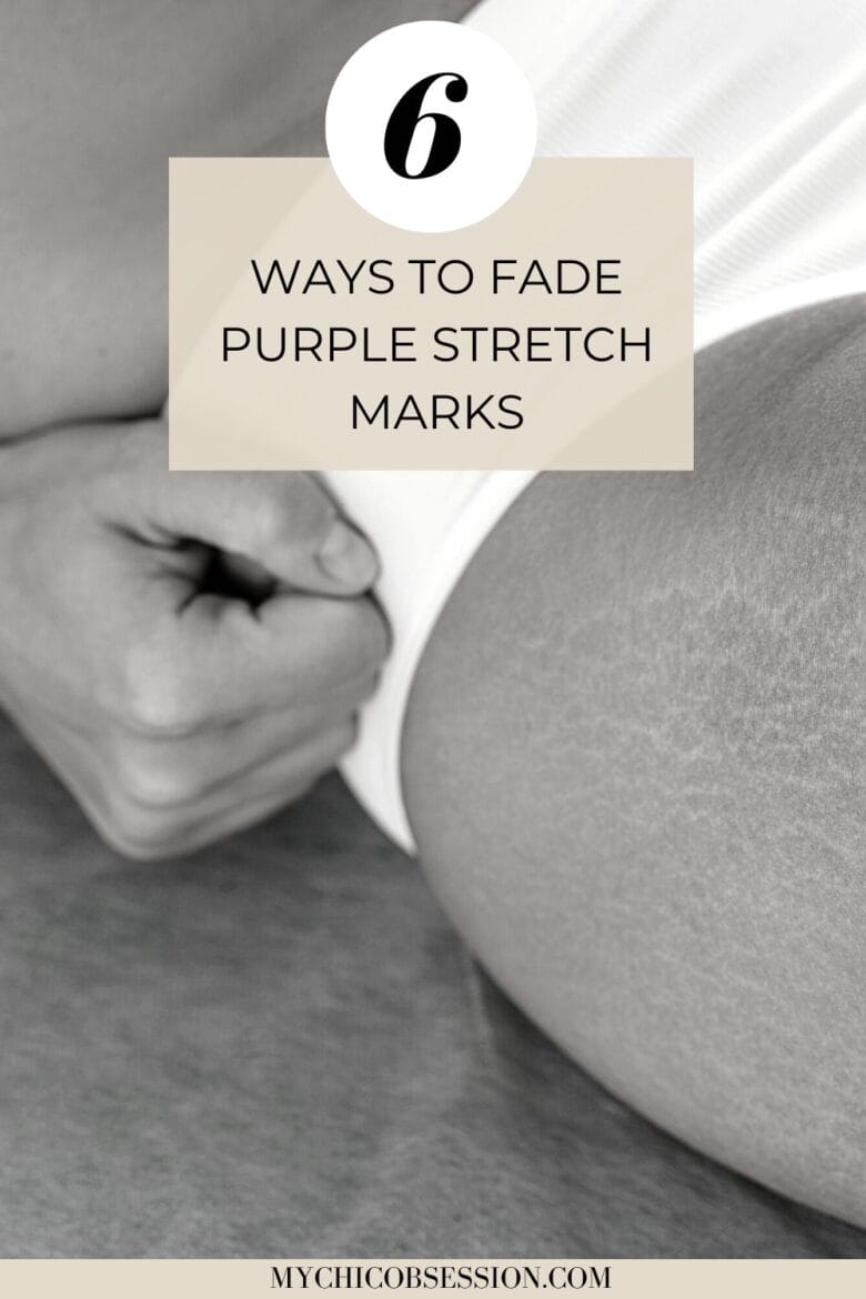 How to Make Purple Stretch Marks Fade - MY CHIC OBSESSION